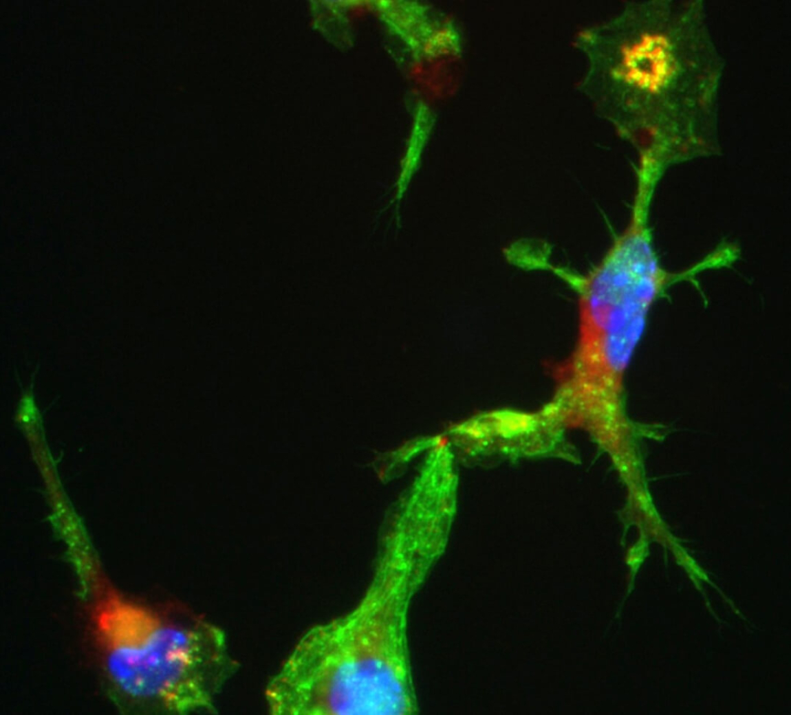 Discovery of a Commonality in Autoimmune Disease | Benaroya Research ...